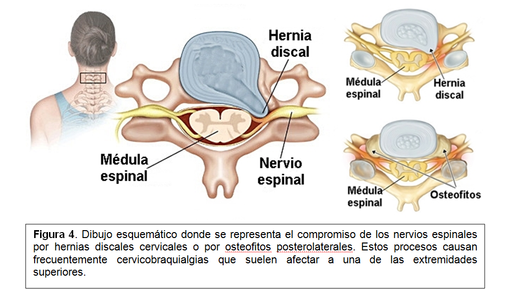 En ActiveSpine tratamos tu dolor cervical con resultados inmejorables
